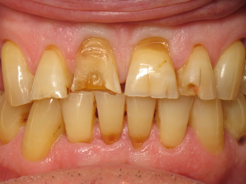 Dental News - Tenet : Time inversion applied to dentistry