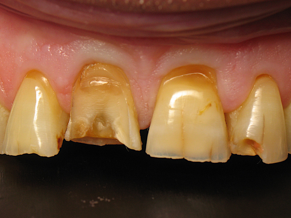 Dental News - Tenet : Time inversion applied to dentistry