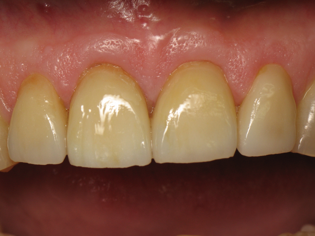 Dental News - Tenet : Time inversion applied to dentistry