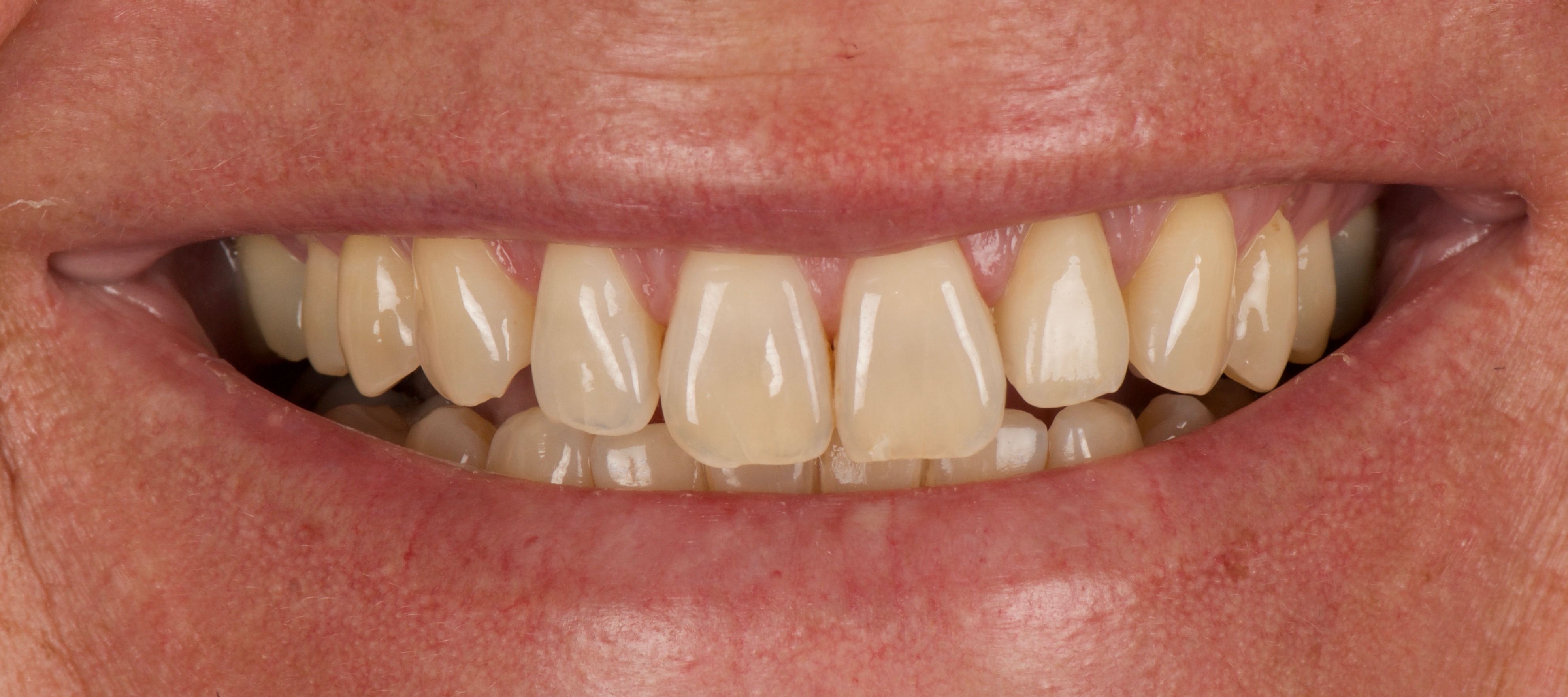 DT News - MEA - Minimally invasive implant therapy in the anterior zone