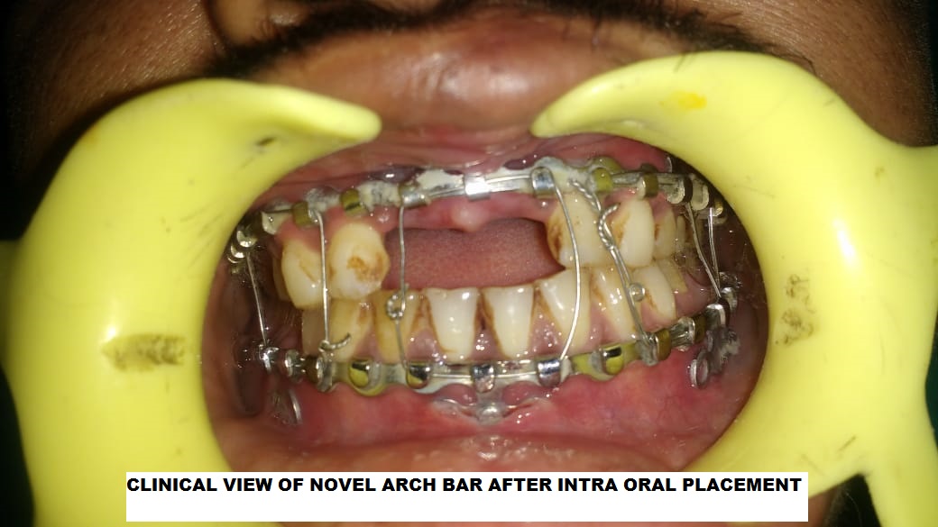 DT News - India - "Novel Arch Bar" patent by Dr. Soumendu Karak, OMFS