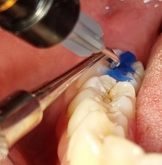 Dental News - The stamp technique: Quick and effective restoration with ...