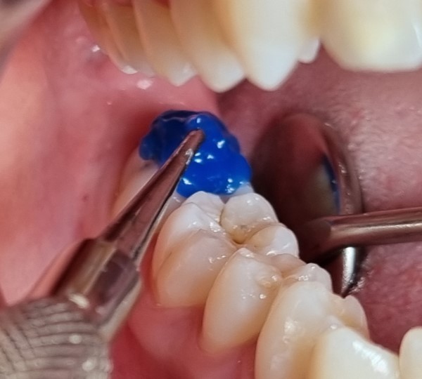 Dental News - The stamp technique: Quick and effective restoration with ...