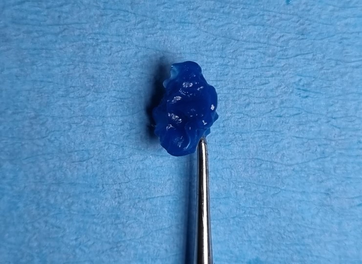 Dental News - The stamp technique: Quick and effective restoration with ...