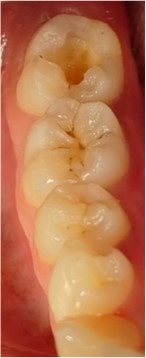 Dental News - The stamp technique: Quick and effective restoration with ...