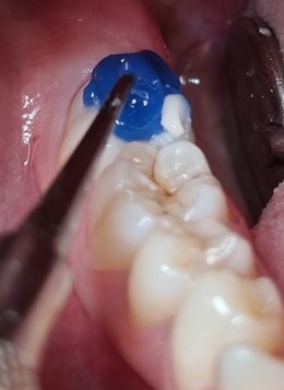 Dental News - The stamp technique: Quick and effective restoration with ...