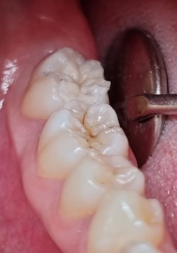 Dental News - The stamp technique: Quick and effective restoration with ...