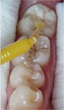 Dental News - The stamp technique: Quick and effective restoration with ...