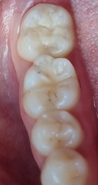 Dental News - The stamp technique: Quick and effective restoration with ...