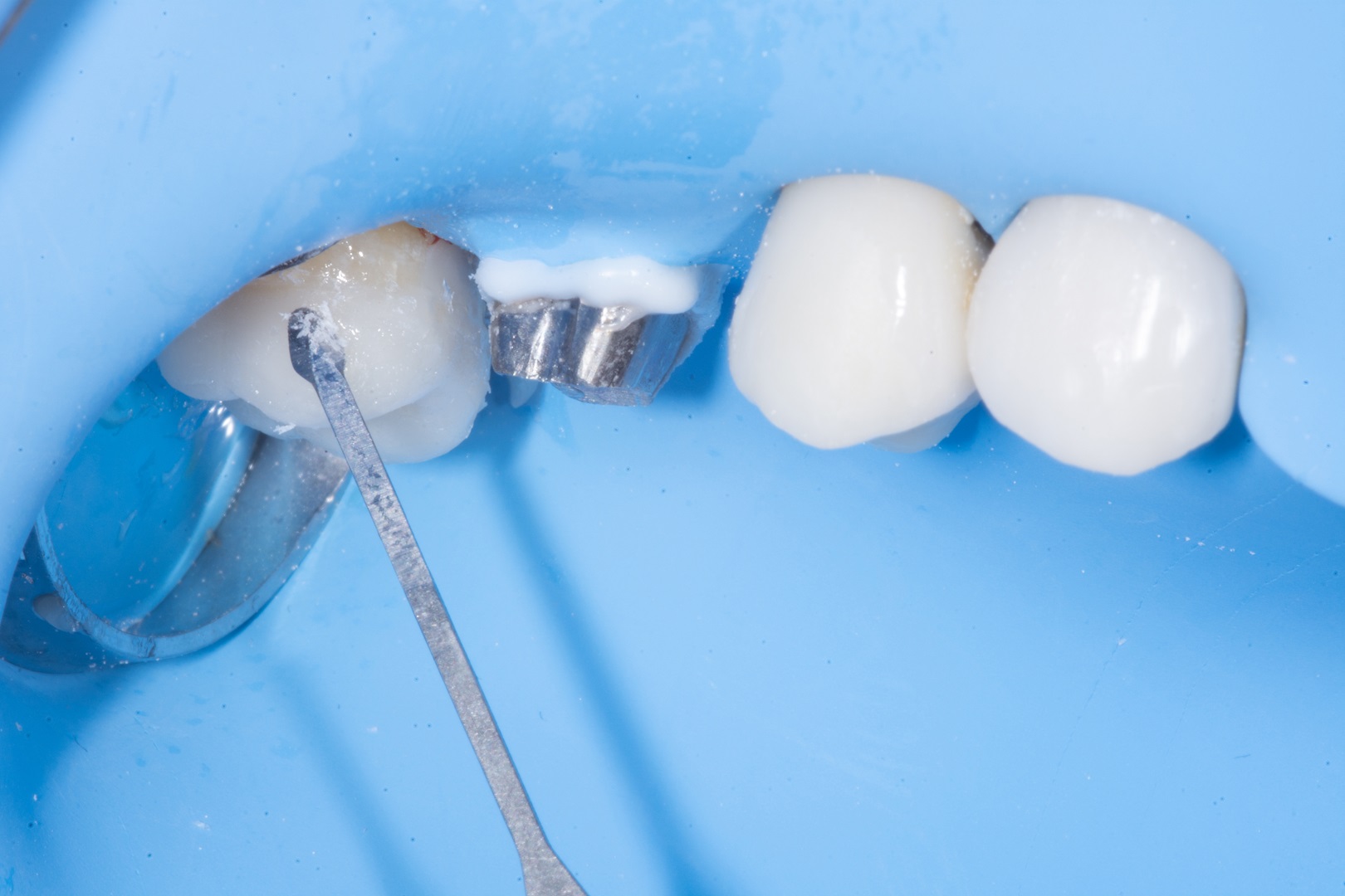 What Is Adhesive Dentistry? | What Adhesive Is Used For Dental Crowns ...