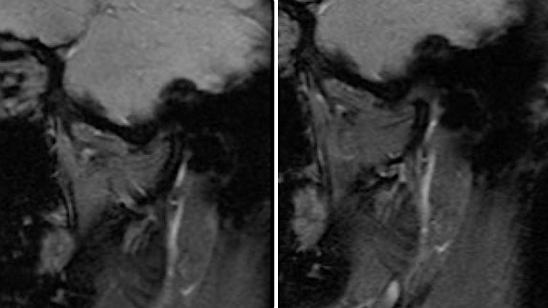Tratamiento quirúrgico mínimamente invasivo de la ATM (1)