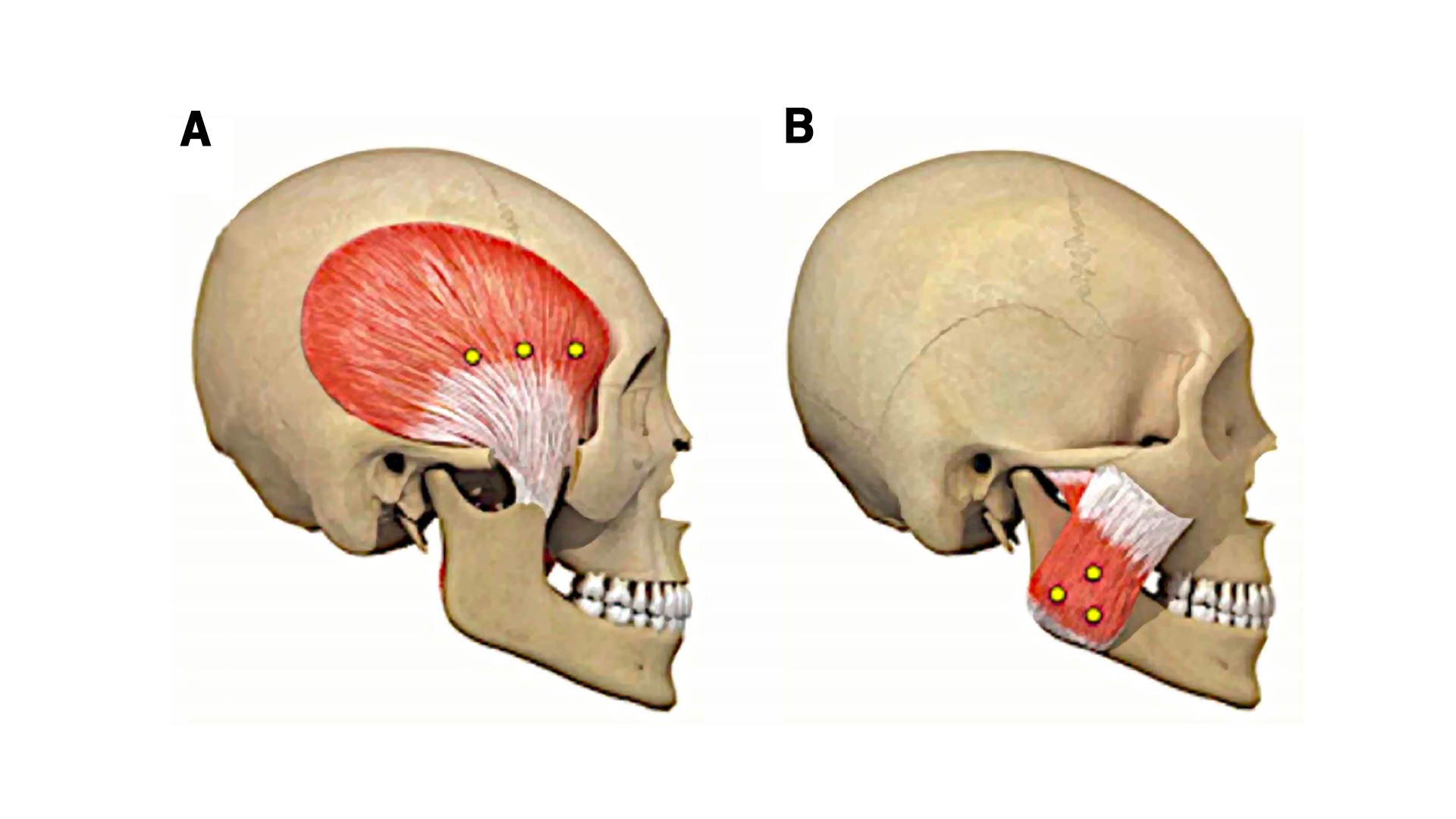 DT News - Latin America - Innovaciones en el manejo del bruxismo y de ...