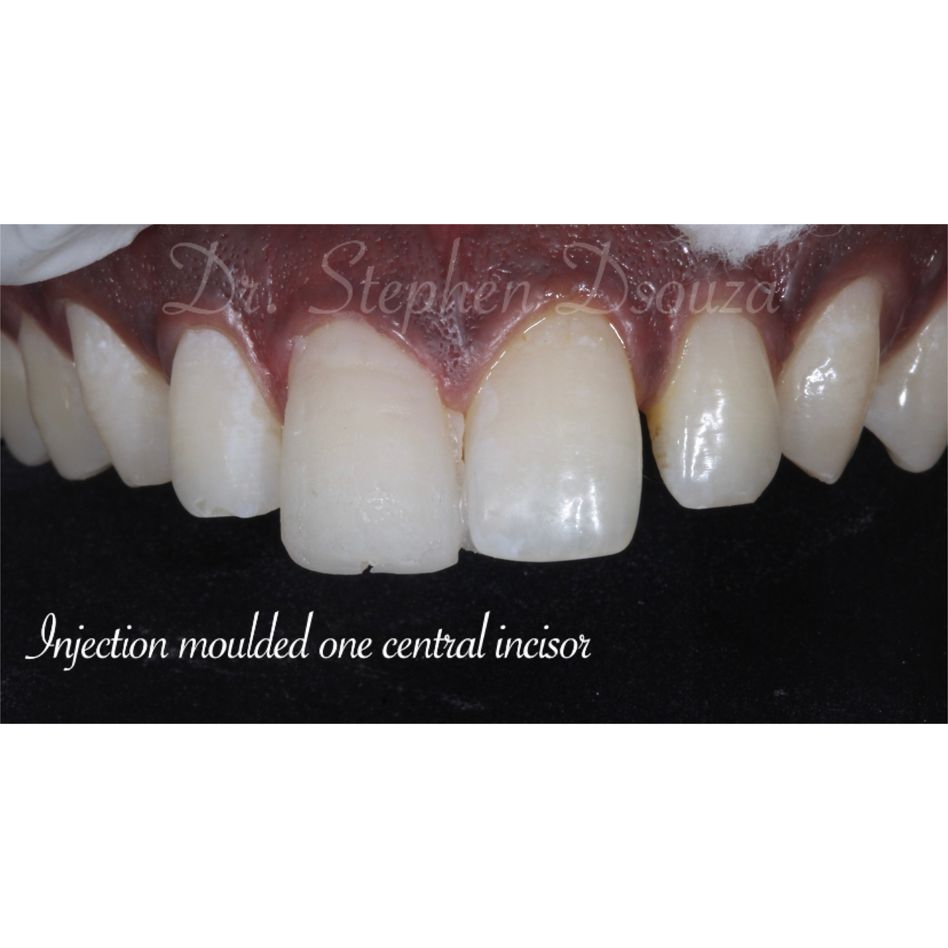 DT News - India - Smile makeover with composite veneers using injection ...