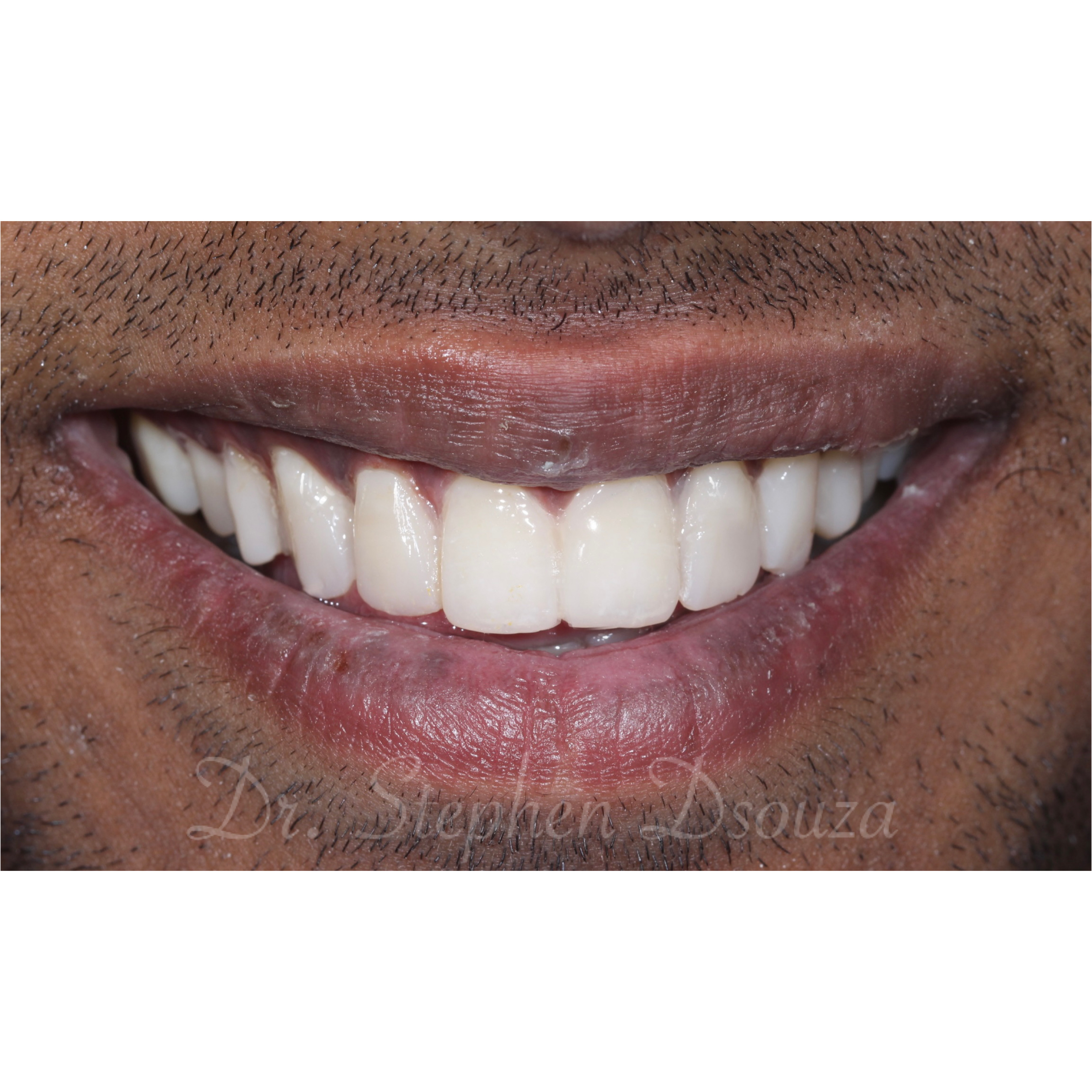 DT News - India - Smile makeover with composite veneers using injection ...