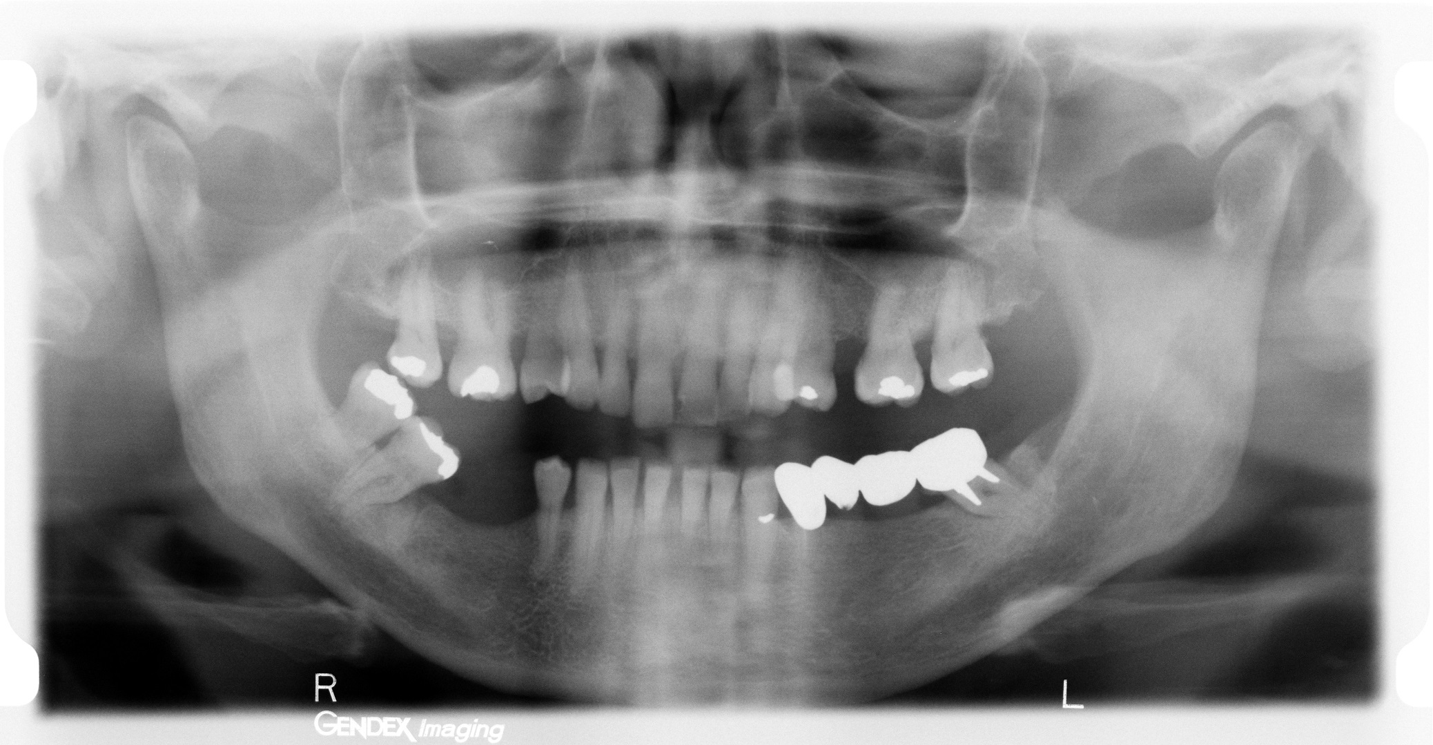 Dental News - Prosthetic rehabilitation with short GTB implants: A case ...