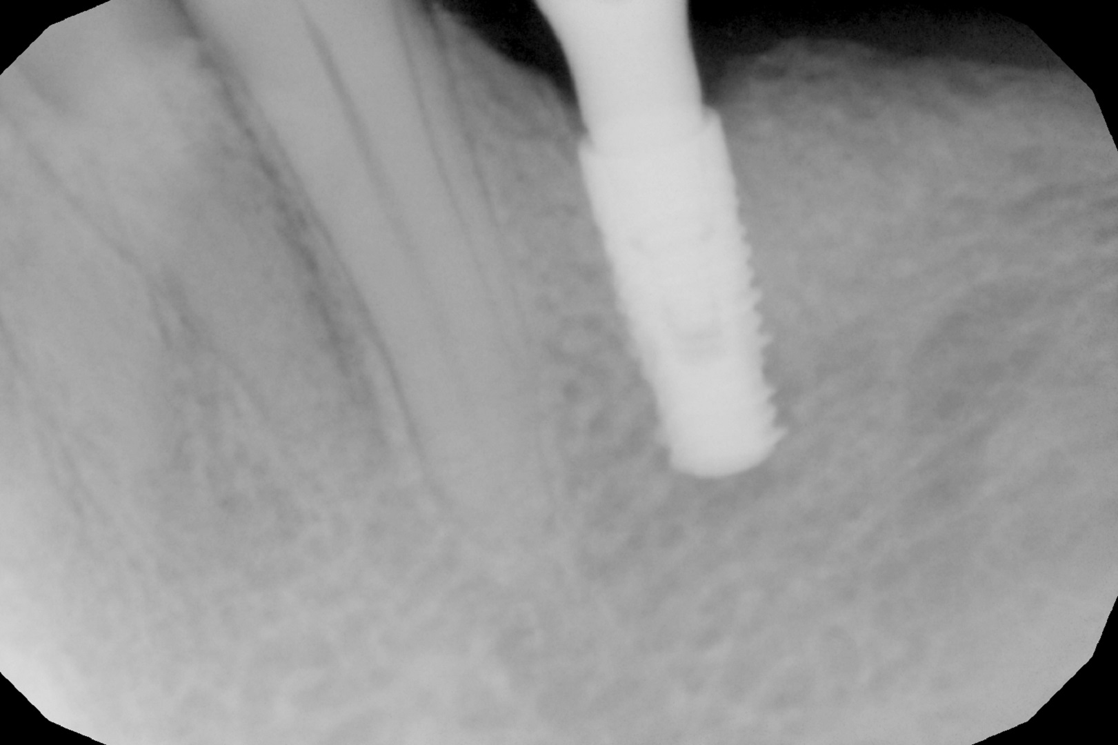 Dental News - Prosthetic rehabilitation with short GTB implants: A case ...