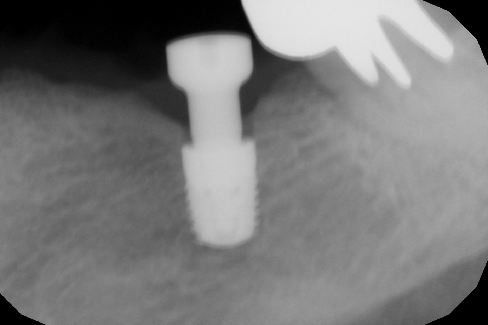 Dental News - Prosthetic rehabilitation with short GTB implants: A case ...