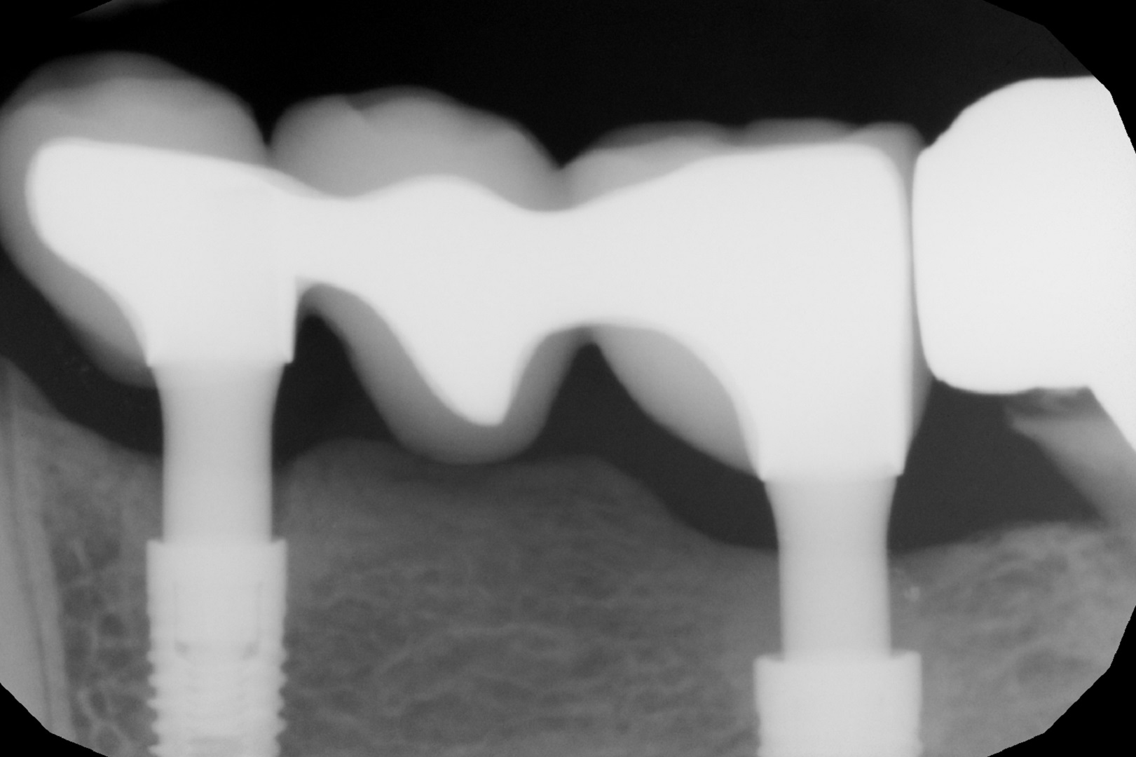 Dental News - Prosthetic rehabilitation with short GTB implants: A case ...