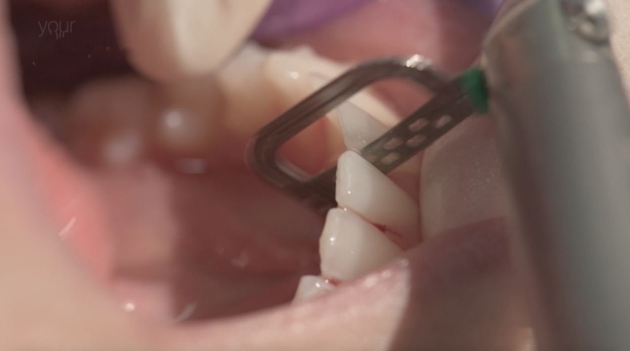 Effective application of interproximal reduction during aligner treatment