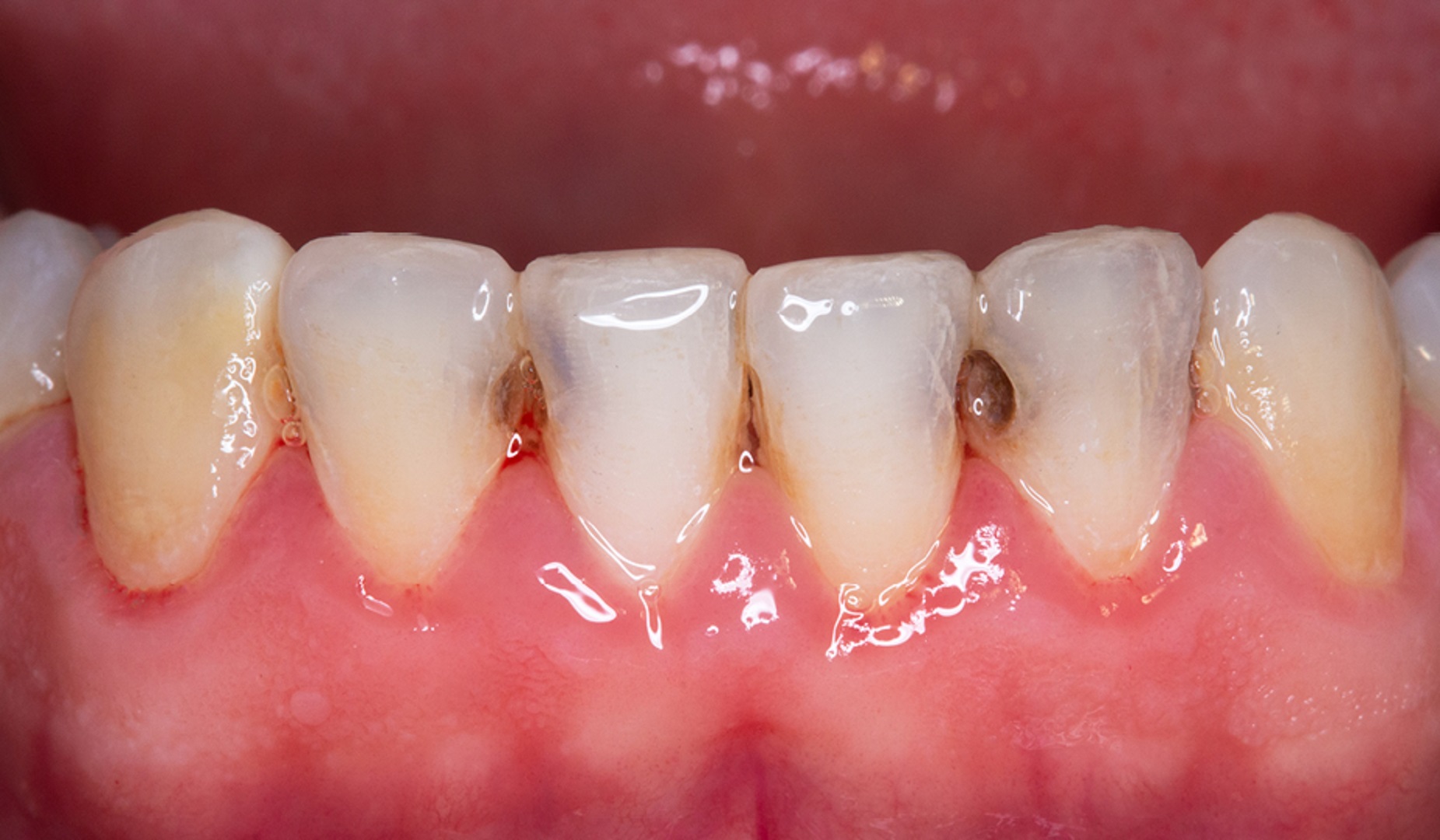Dental News - Simplified direct restoration procedure in the mandibular ...