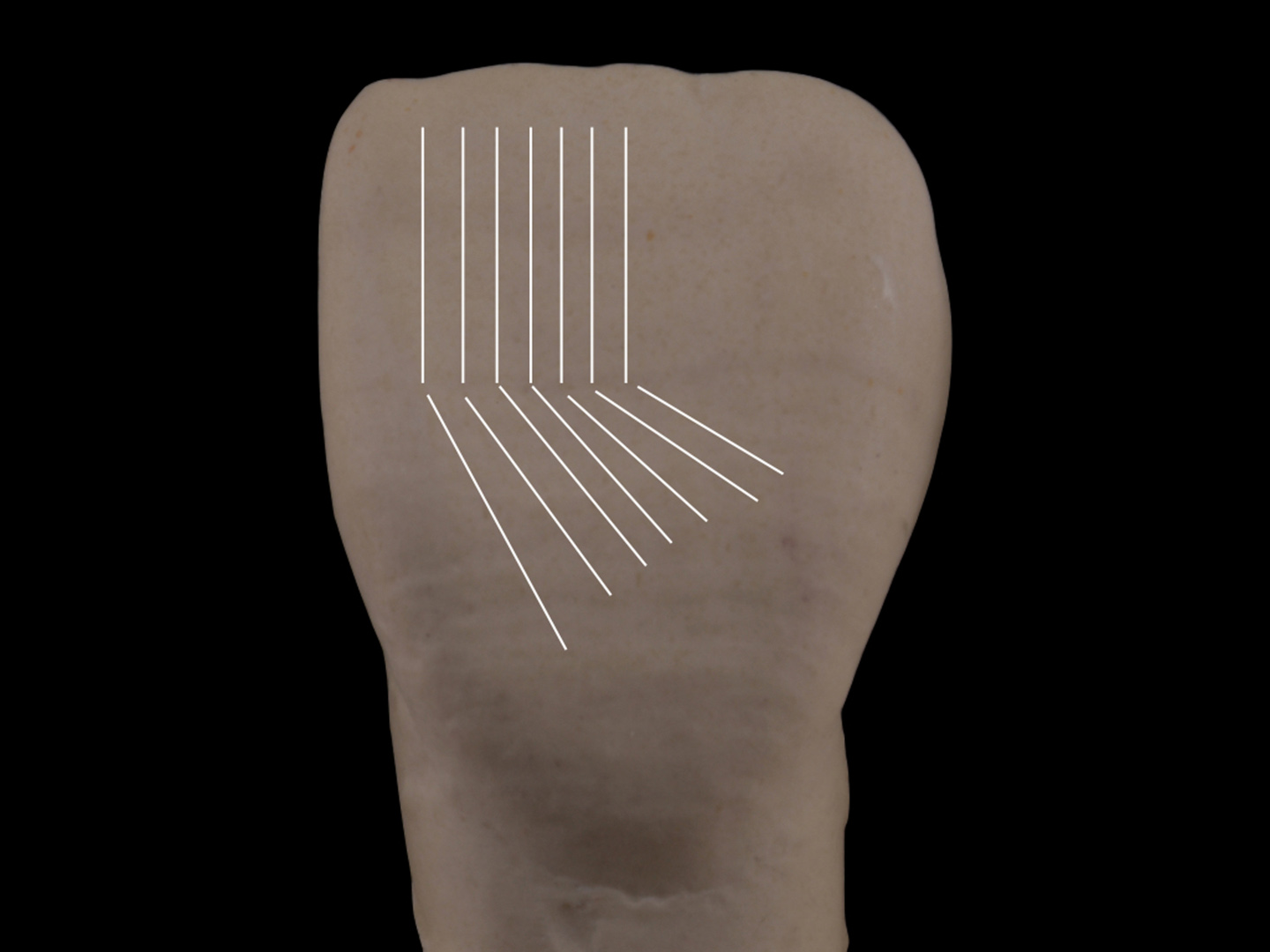 Dental News - Surface texture: Using horizontal and vertical lines to ...