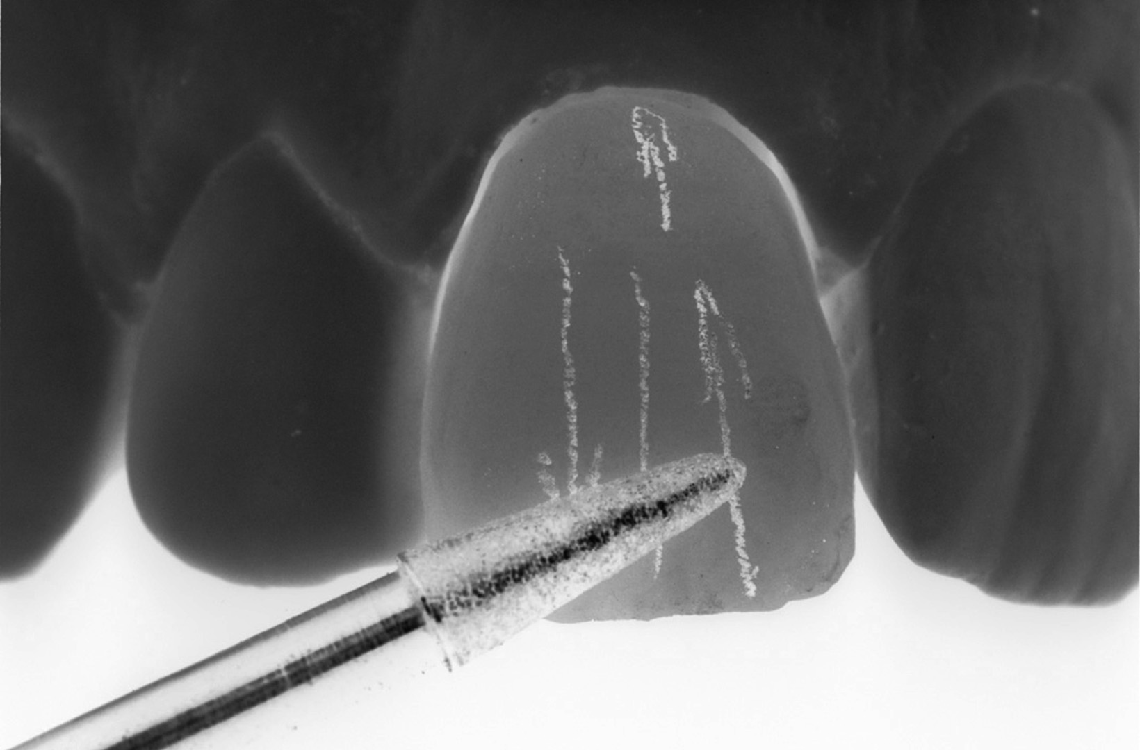 Dental News - Surface texture: Using horizontal and vertical lines to ...