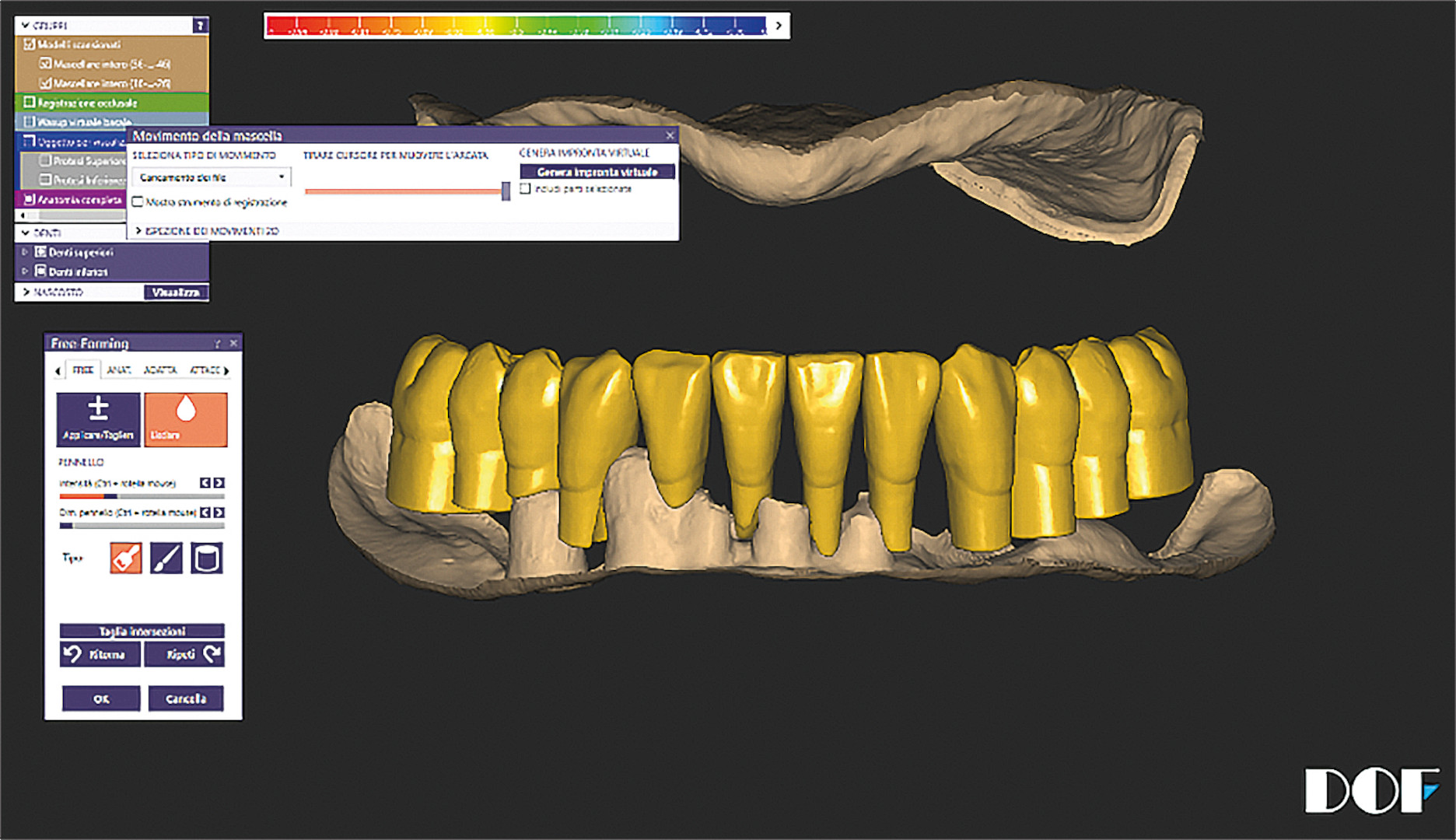 Dental News - Production of complete maxillary and mandibular dentures ...