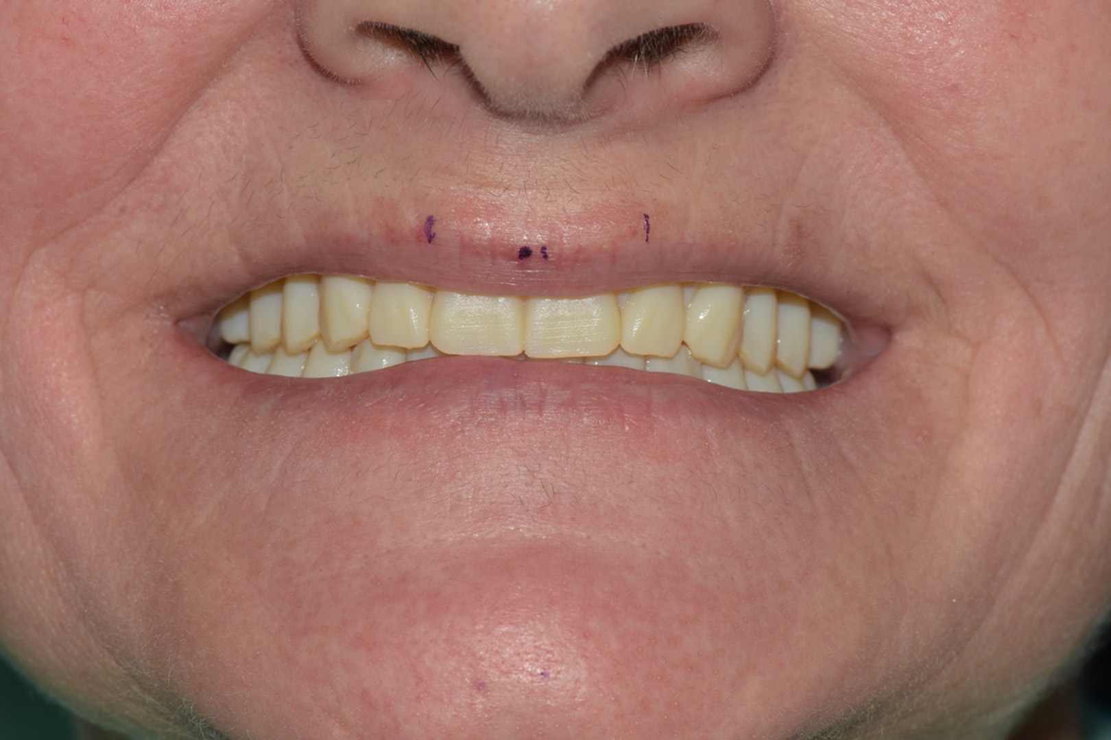 Dental News - Production of complete maxillary and mandibular dentures ...