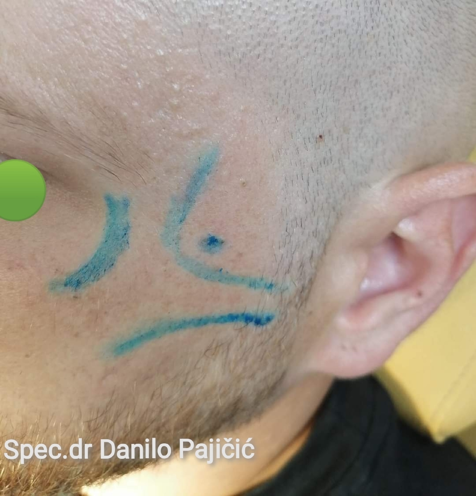 DT News - Serbia & Montenegro - Hirurško uklanjanje retencione ciste ...