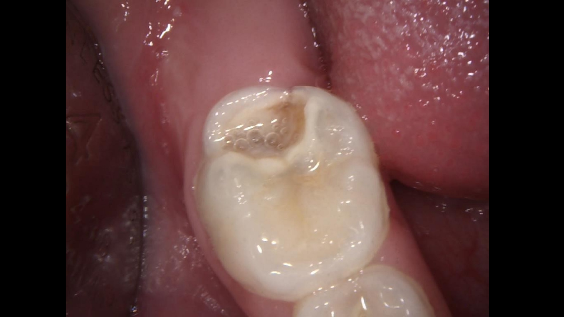 Dental News - Root canal therapy of necrotic primary molars—using a ...
