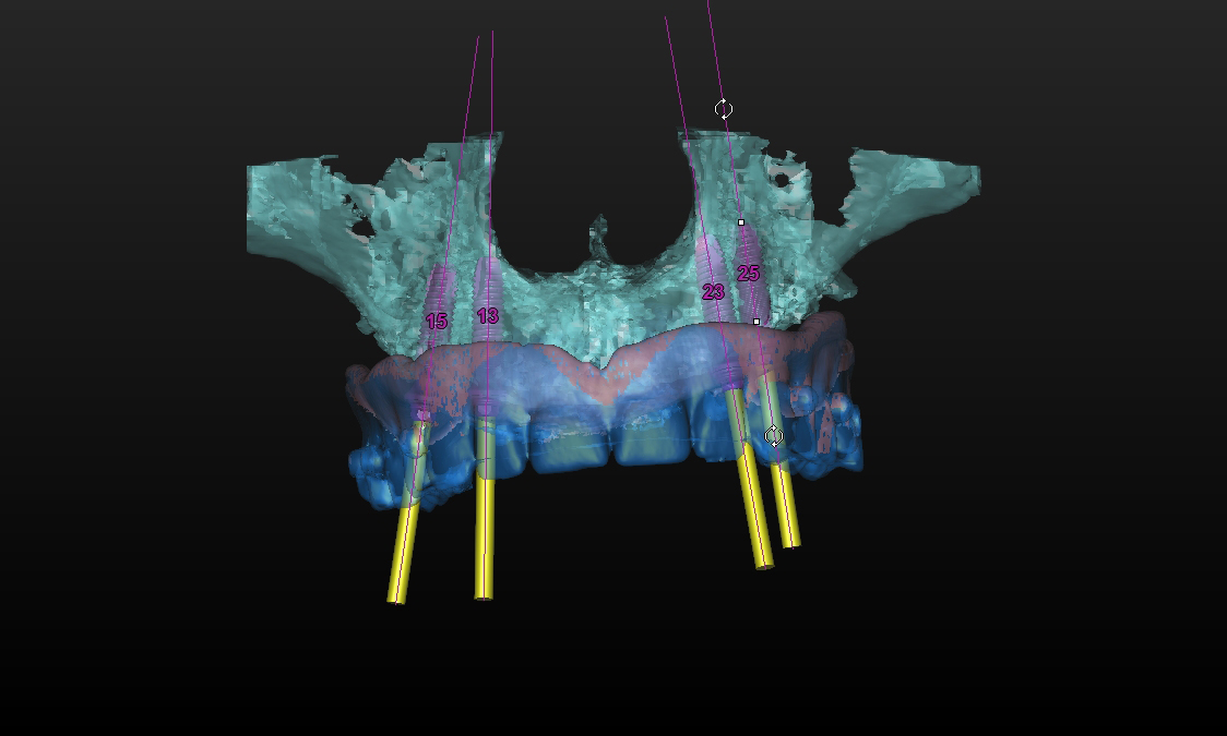 Dental News - Immediate restoration of an edentulous maxilla