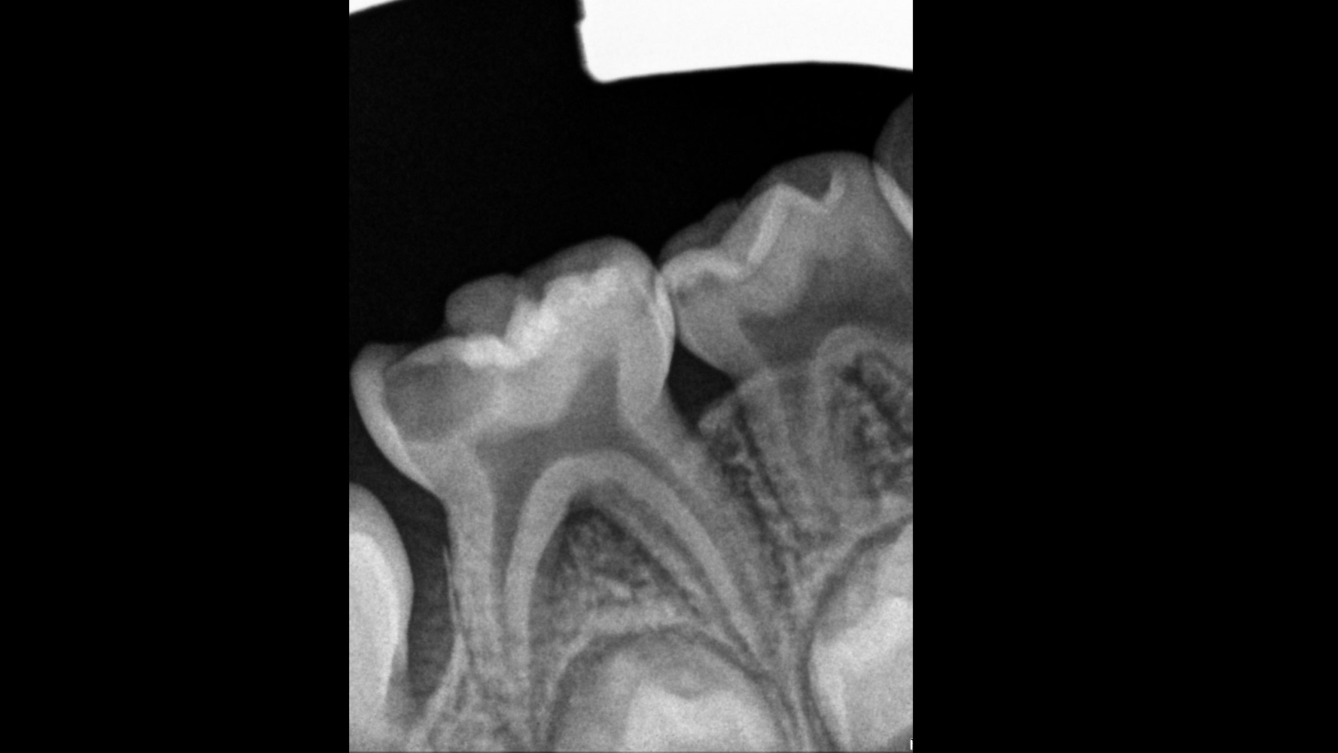 Dental News - Root canal therapy of necrotic primary molars—using a ...
