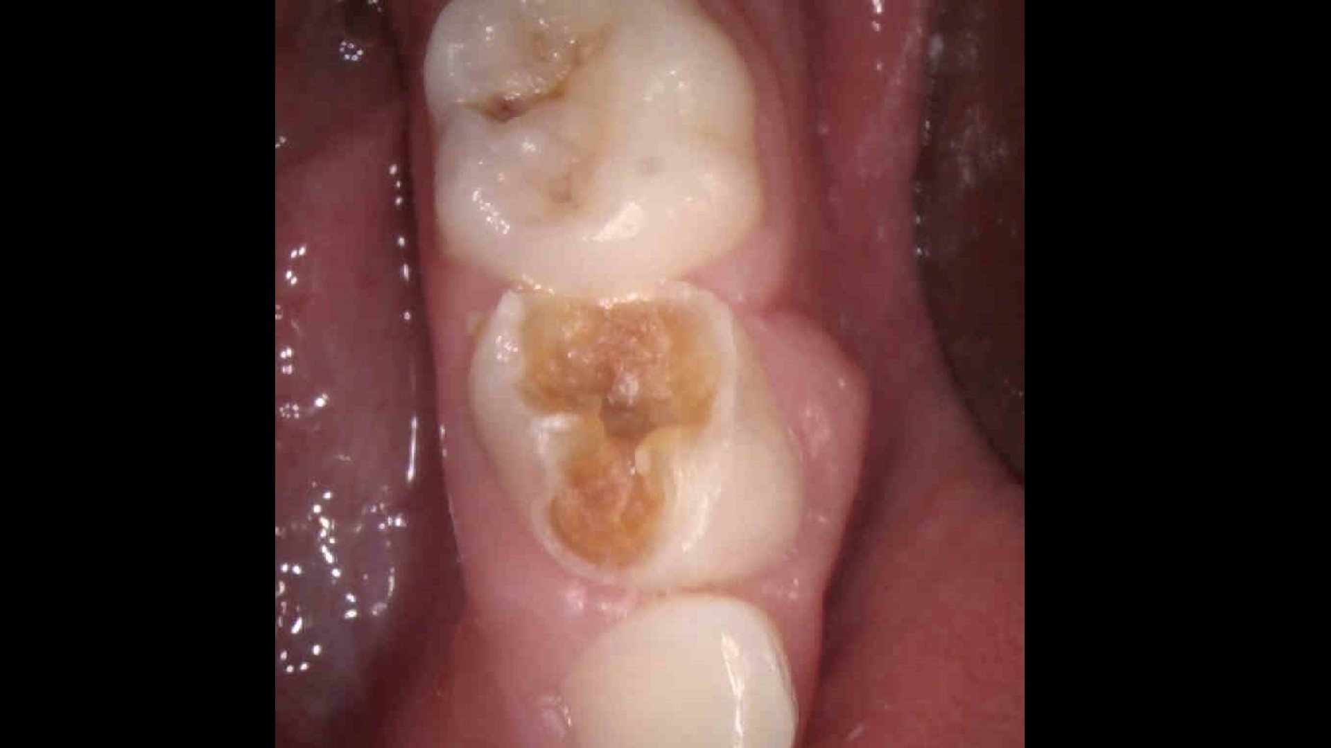 Dental News - Root canal therapy of necrotic primary molars—using a ...
