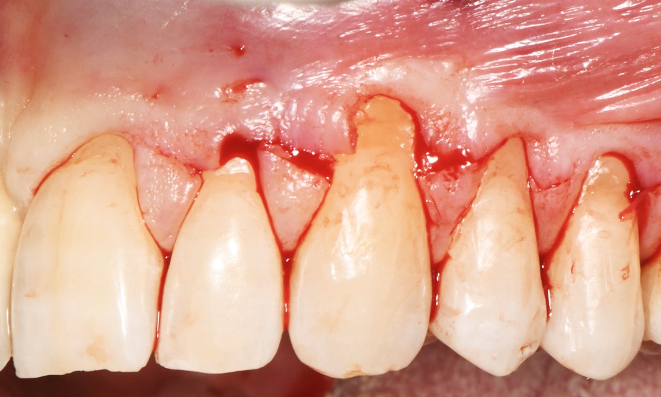 DT News - Italy - Trattamento di recessioni gengivali multiple mediante tecnica MCAF associata ...
