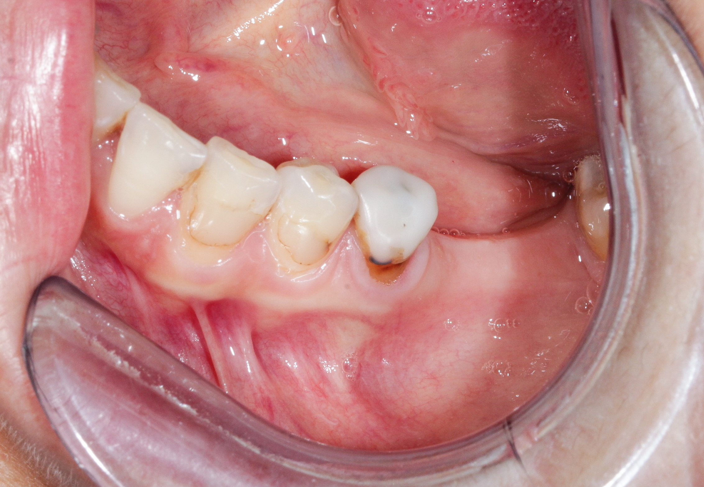 Dental News - Radicular transplantation—The use of dental roots in the ...