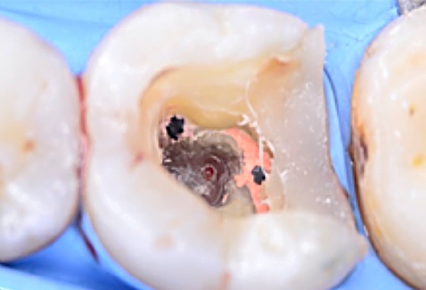 Retratamiento no quirúrgico de una perforación