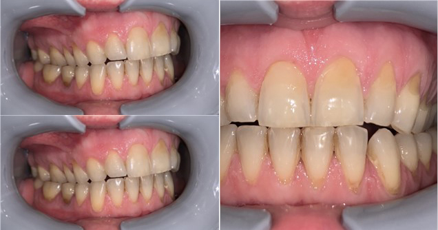 DT News - Italy - Workflow digitale in gnatologia. Caso clinico