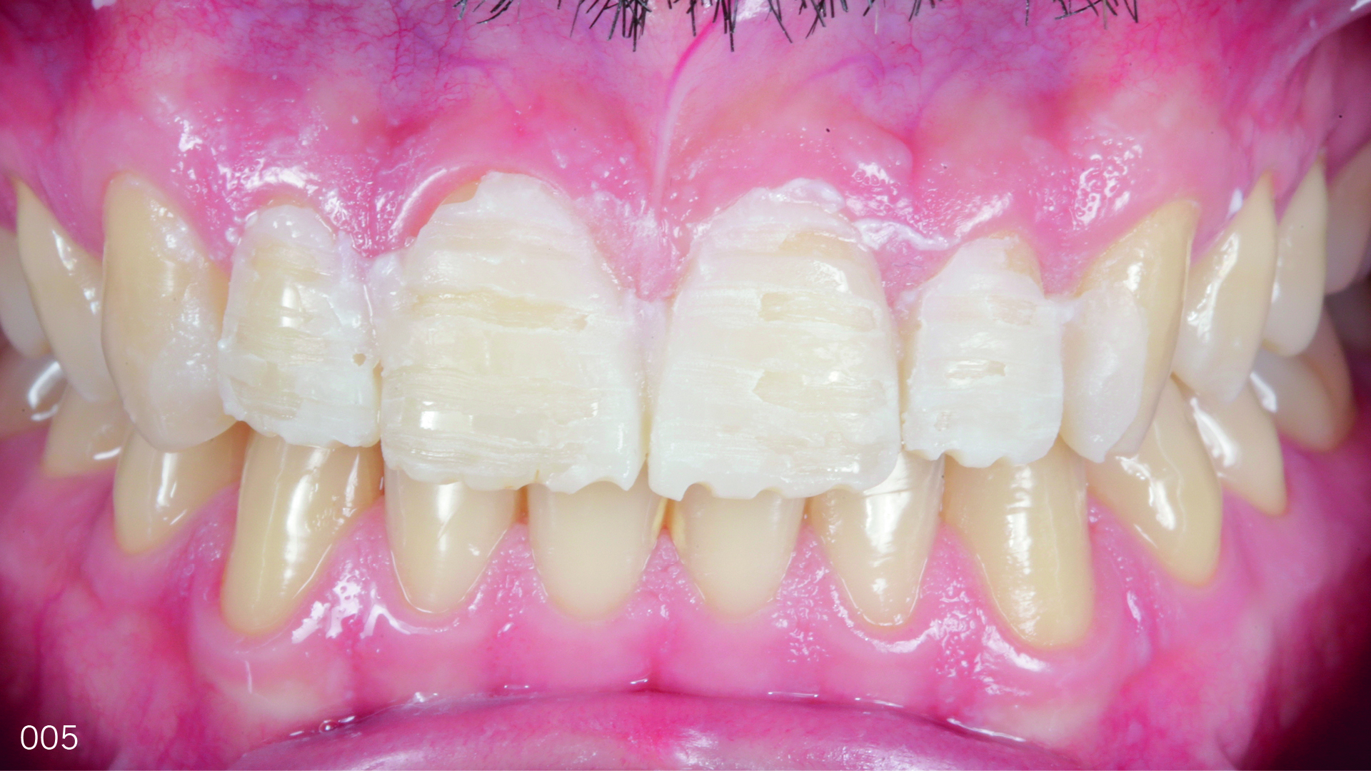 Dental News - Extremely minimally invasive mock-up-guided veneer ...