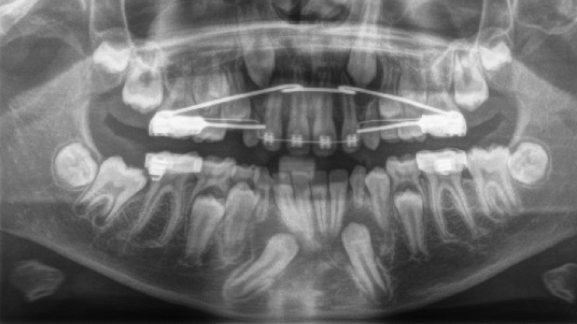 DT News - Italy - Terapia chirurgico-ortodontica di un canino ...