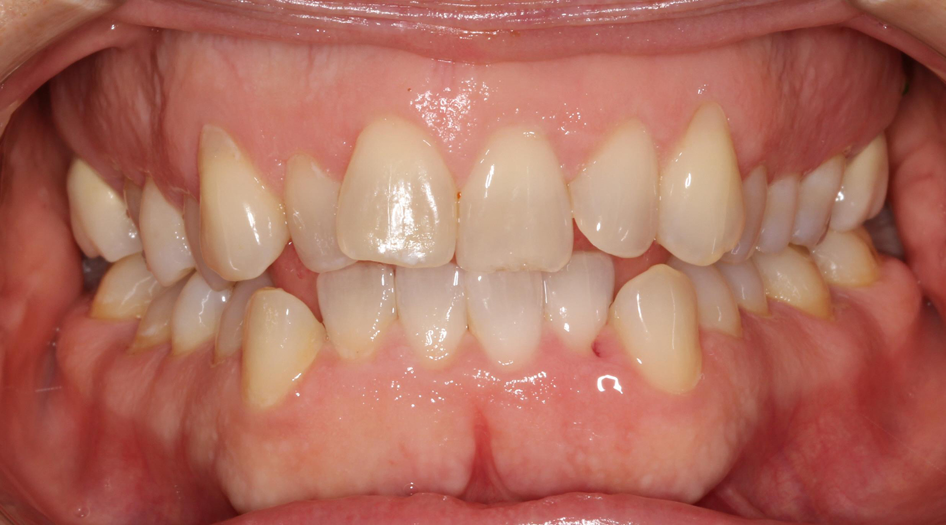 Dental News - Case study: Class I crowded malocclusion with moderate ...