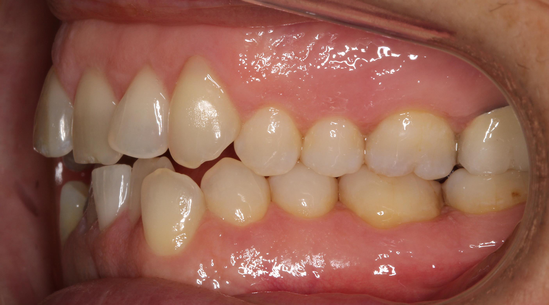 Dental News - Case study: Class I crowded malocclusion with moderate ...