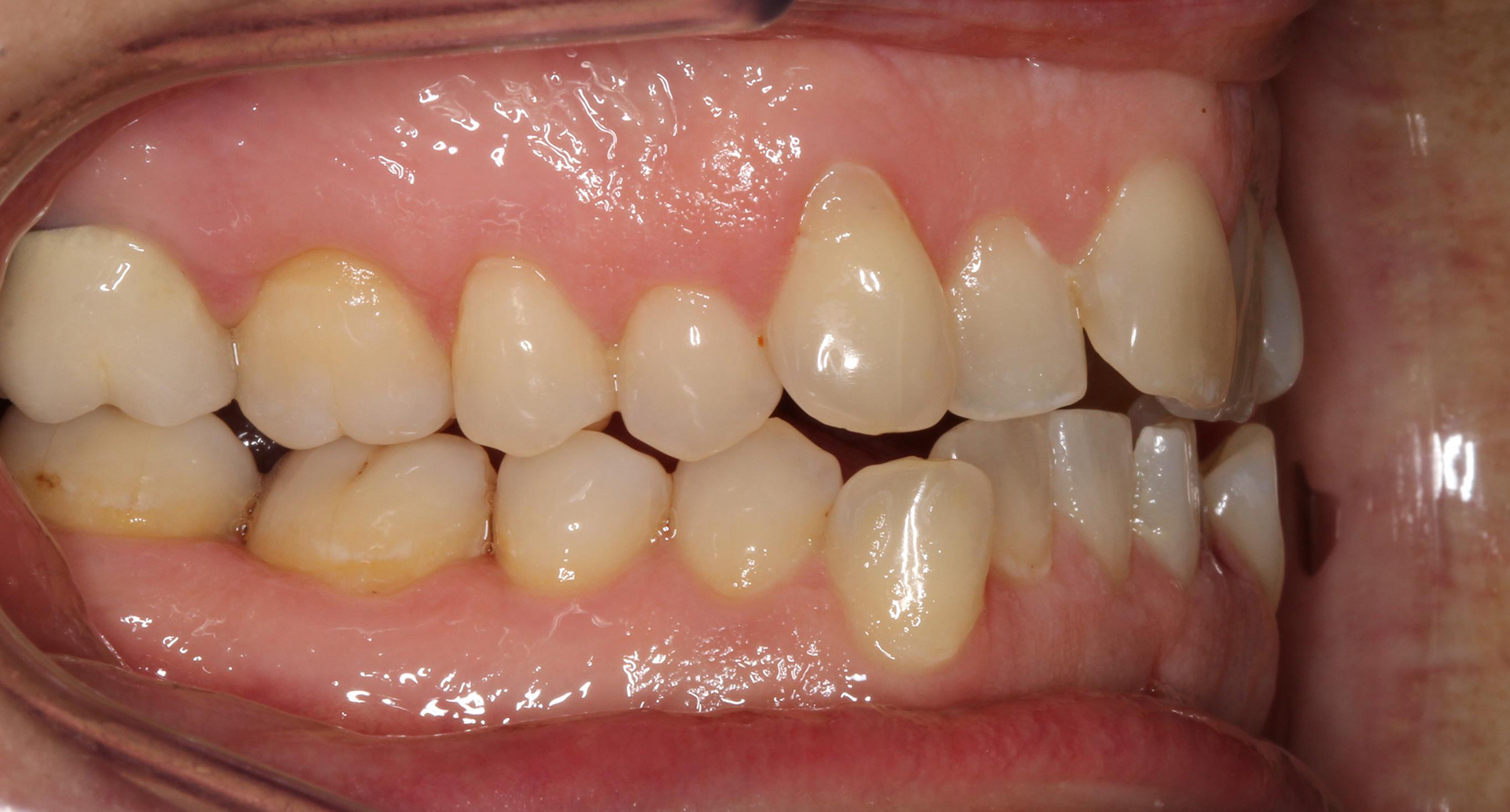 Dental News - Case study: Class I crowded malocclusion with moderate ...