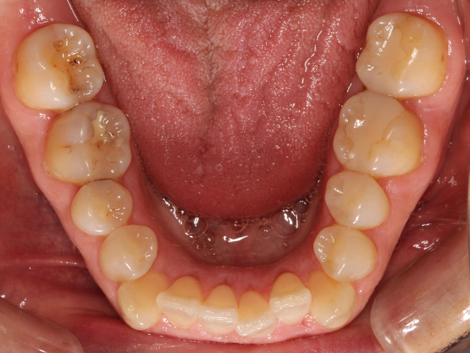Dental News Case Study Class I Crowded Malocclusion With Moderate