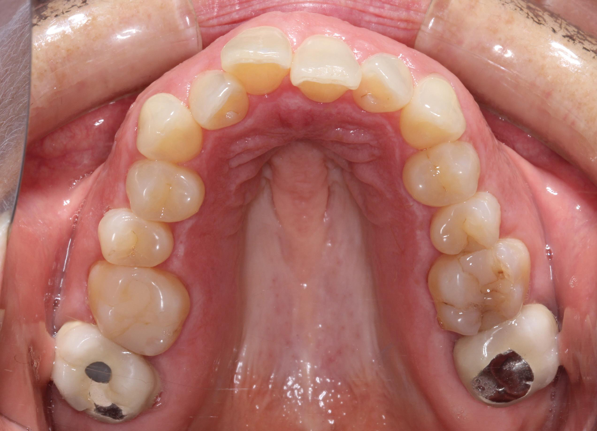 Dental News - Case study: Class I crowded malocclusion with moderate ...