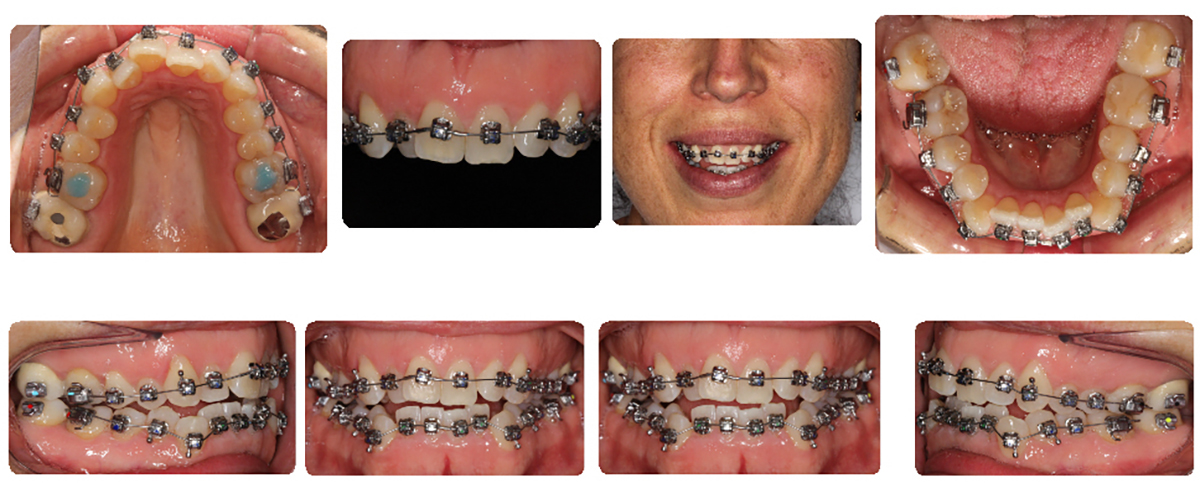 Dental News Case Study Class I Crowded Malocclusion With Moderate