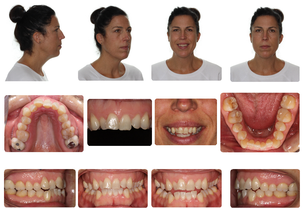Dental News - Case study: Class I crowded malocclusion with moderate ...