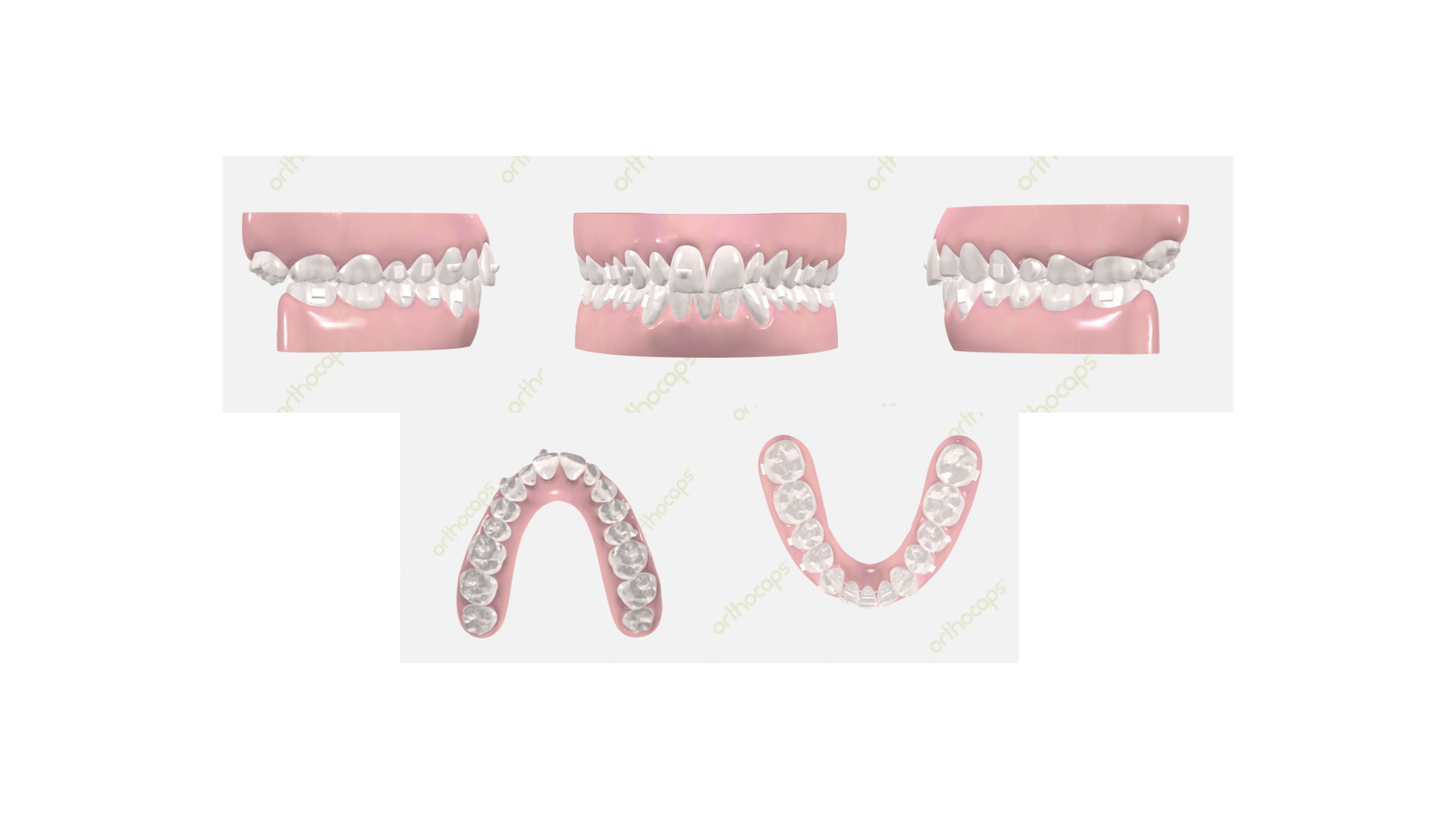 A Class II open bite case