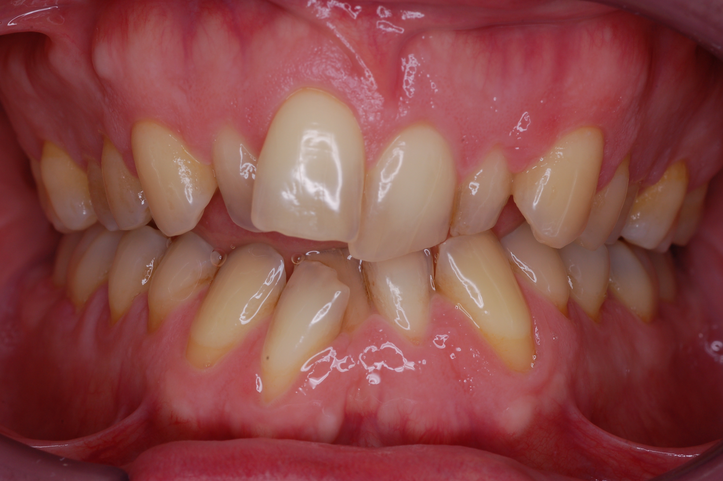 A Class II open bite case