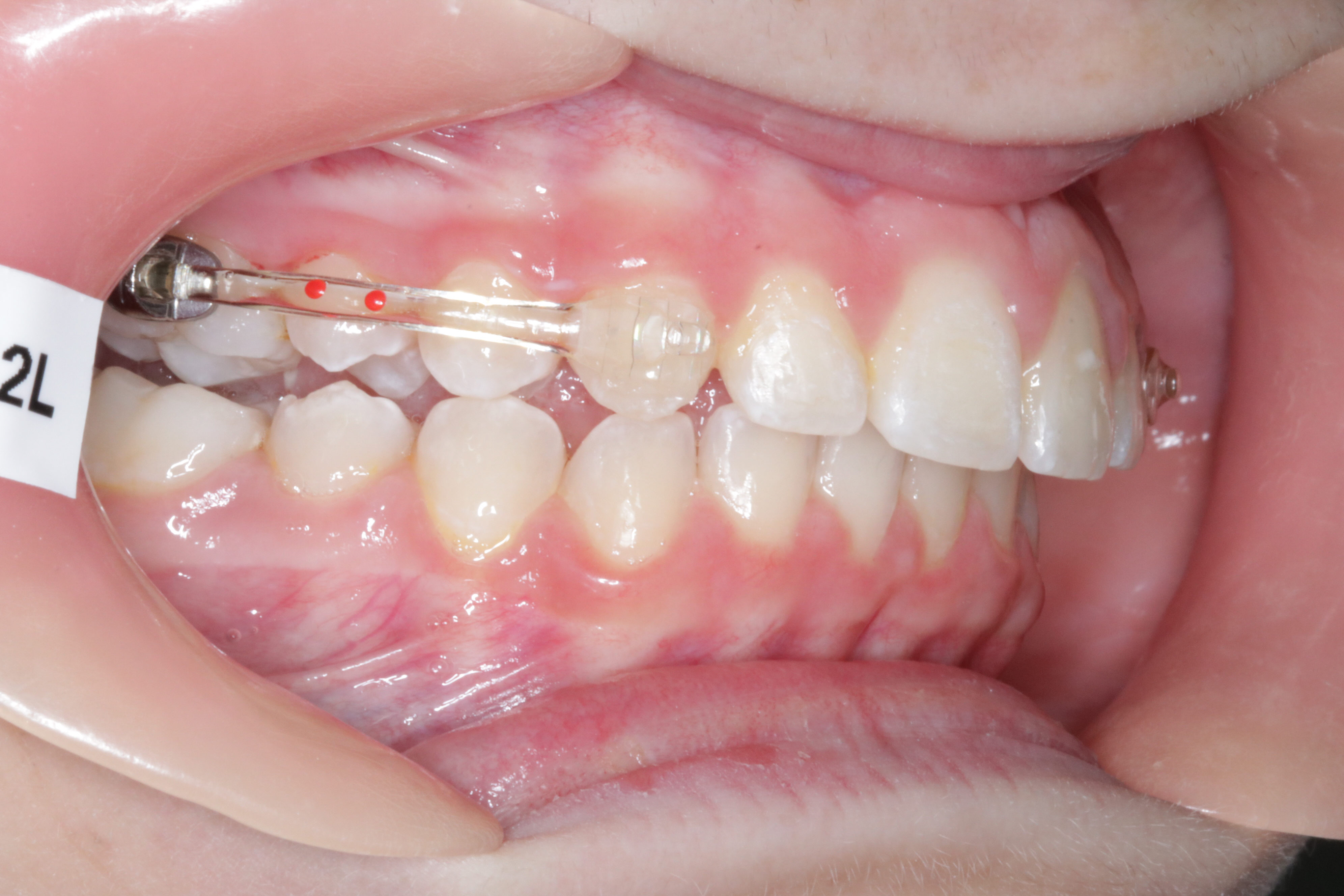 Boosting facial aesthetics through a hybrid approach of the Carriere ...