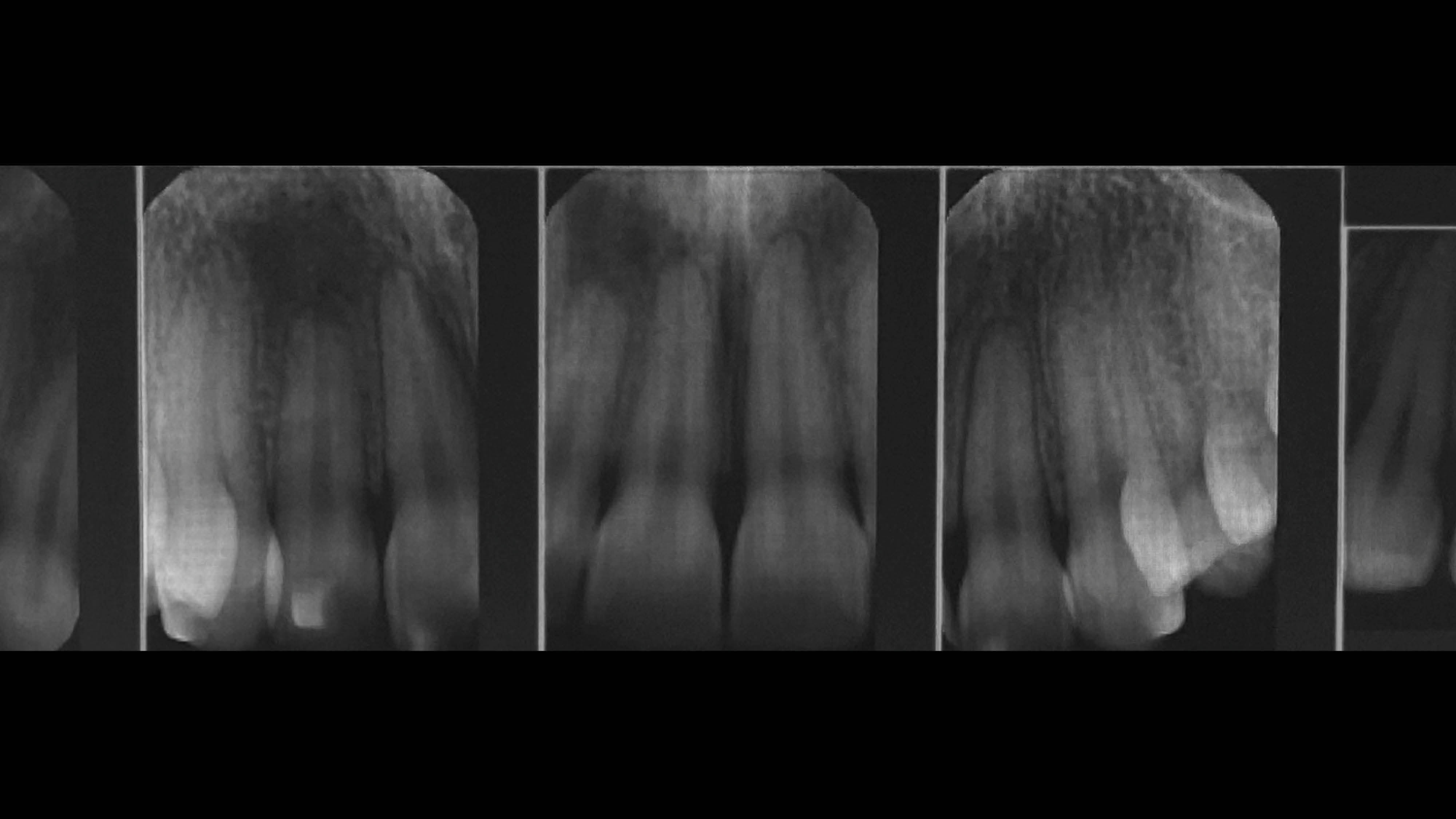 DT News - Italy - Progettazione della terapia chirurgica dell’eruzione passiva alterata: l ...